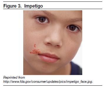 Impetigo Nhs